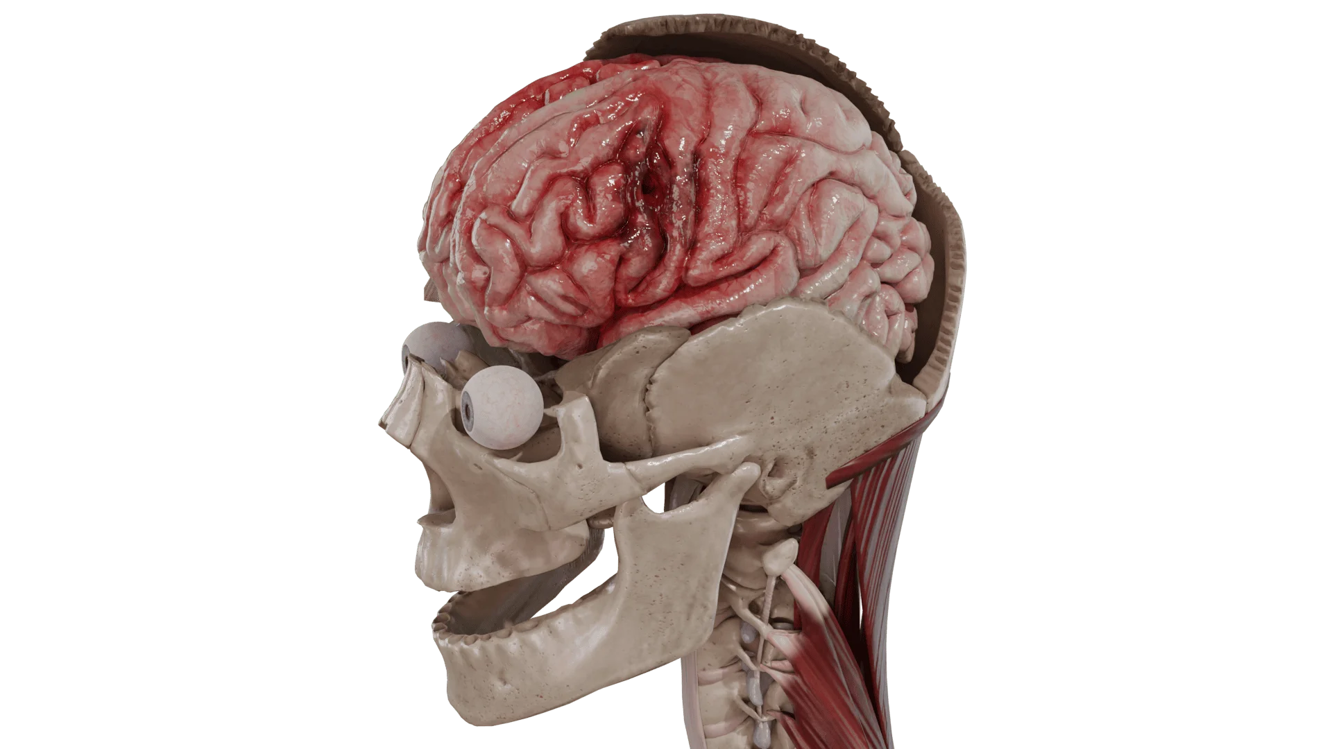 3D Model of Gunshot Wounds of Skull and Brain | VOKA